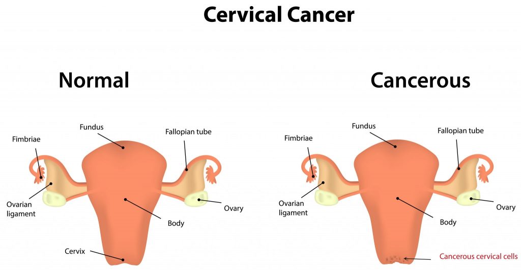 Son Todos Los Carcinomas De C ncer Startupassembly co Son Todos Los Carcinomas De C ncer Startupassembly co
